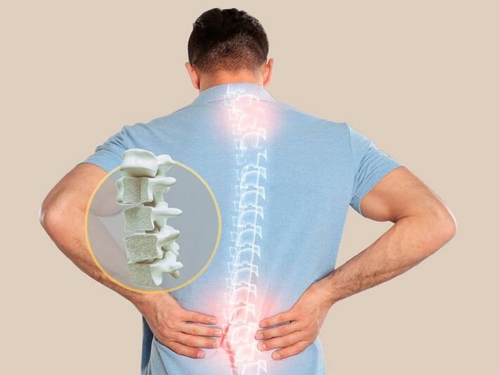 Bone Loss From Osteoporosis: Air Pollution Can Damage Your Bone Health ...