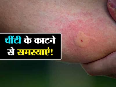 Insect bite : चींटी के डंक में इस एसिड की वजह से होती है खुजली और ...