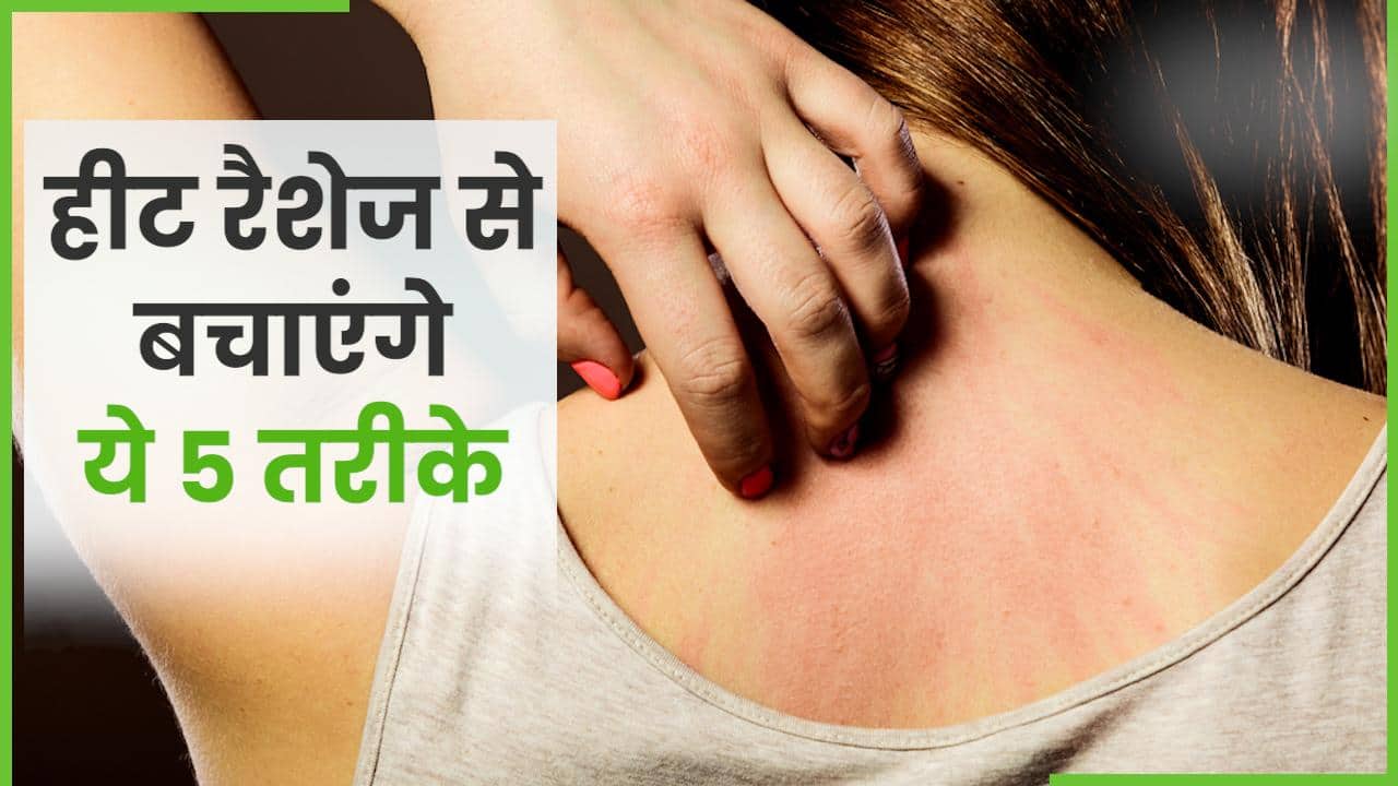 Heat Rashes से हैं परेशान तो अपनाएं ये 5 घरेलू तरीके, Watch Video ...