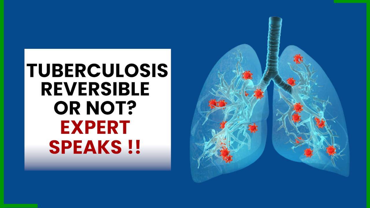 Tuberculosis Treatment: How TB Patients Health Can Become Better ...