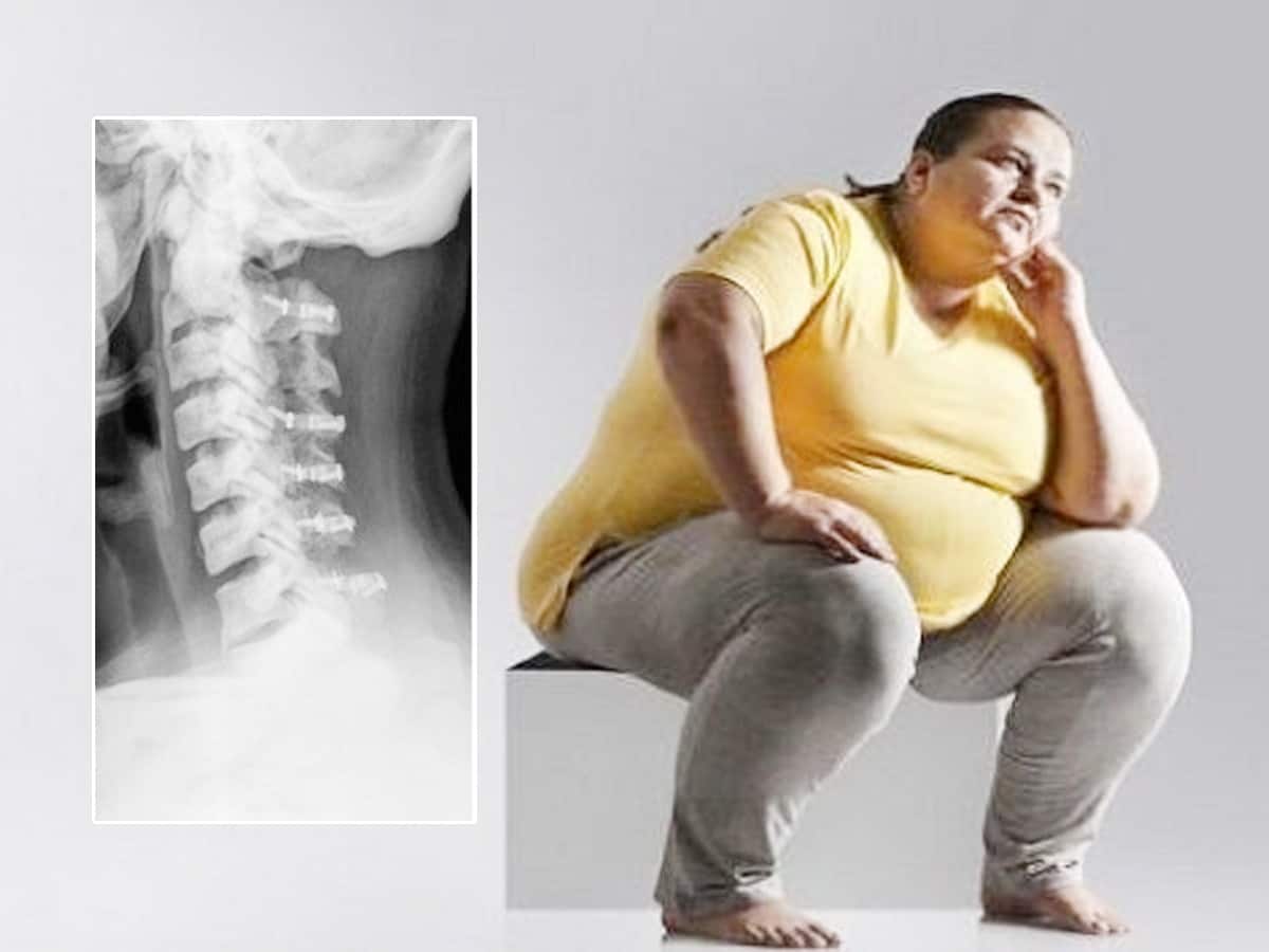 Obesity Can Lead To Cervical Ossification: Here’s What You Can Do To Avoid It | TheHealthSite.com