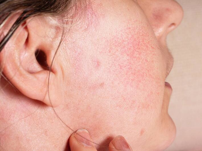 Alcohol effects on skin : Skin के लिए 5 तरीकों से 'जहर' समान है Alcohol ...