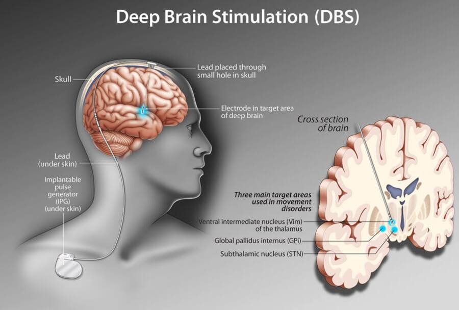 Deep Brain Stimulation for Parkinson's Disease: What is It, Advantages, Side Effects And More ...