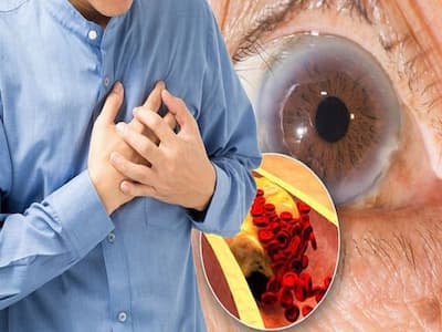 High Cholesterol Symptoms: 5 Warning Signs That Appear In Eyes, Legs ...