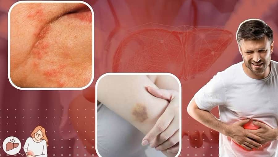 Liver Cirrhosis Symptoms 9 Warning Skin Signs Of Liver Disease You