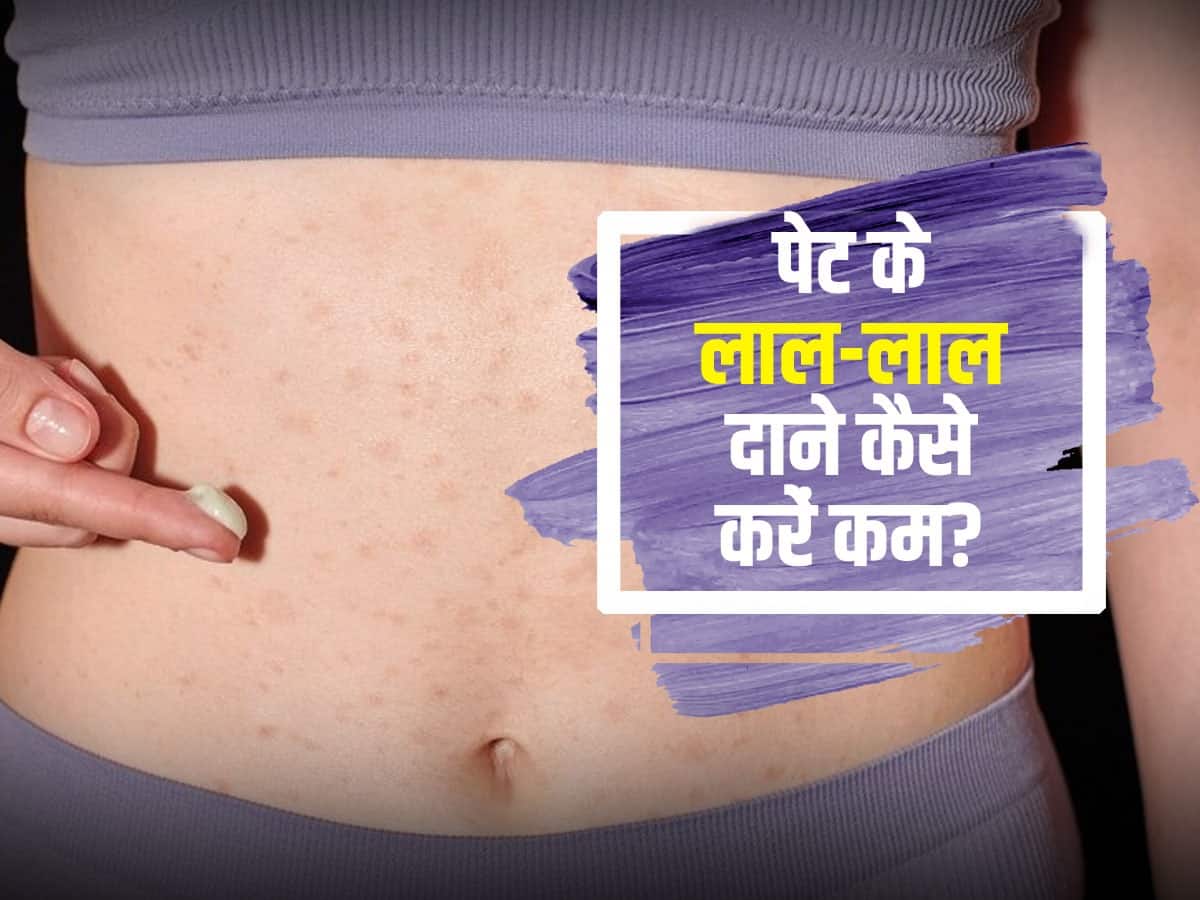 Stomach Rashes : पेट पर छोट-छोटे लाल दाने आपके साड़ी लुक को कर सकते हैं ...