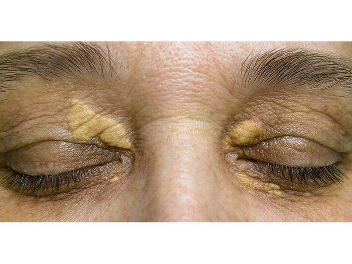 High Cholesterol signs on face : चेहरे पर दिखने वाले ये 4 संकेत मतलब ...