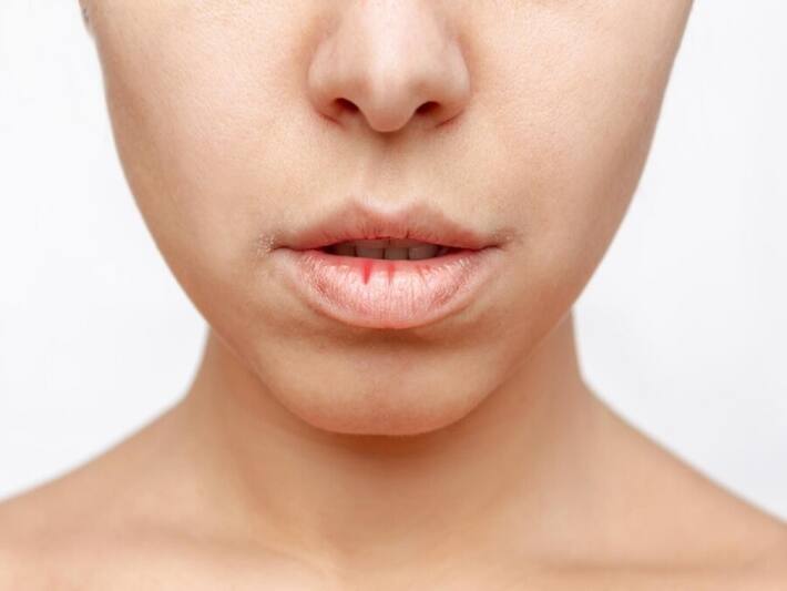 Medical Conditions That Can Cause Chapped Lips