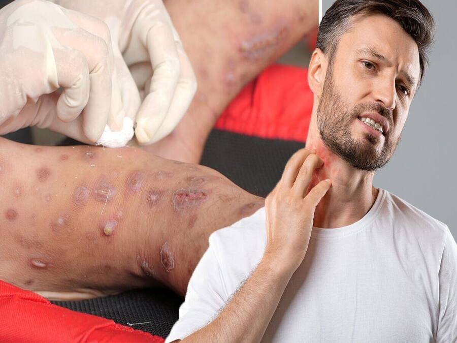 Symptoms Of Stds That Can Appear On Your Face