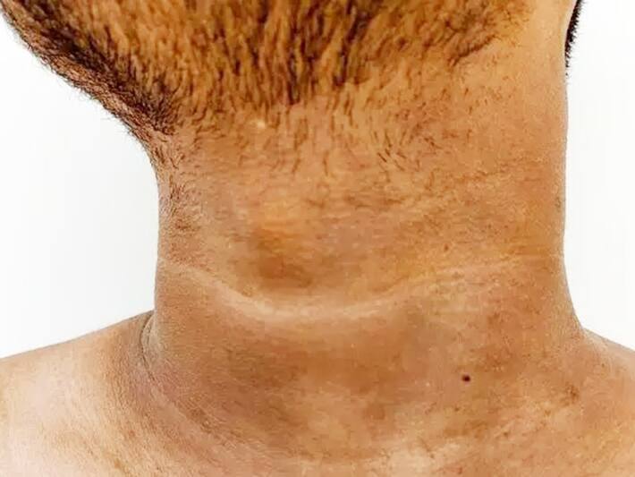 Diabetes Signs on Skin : Blood Sugar बढ़ने पर स्किन में होने लगते हैं ...