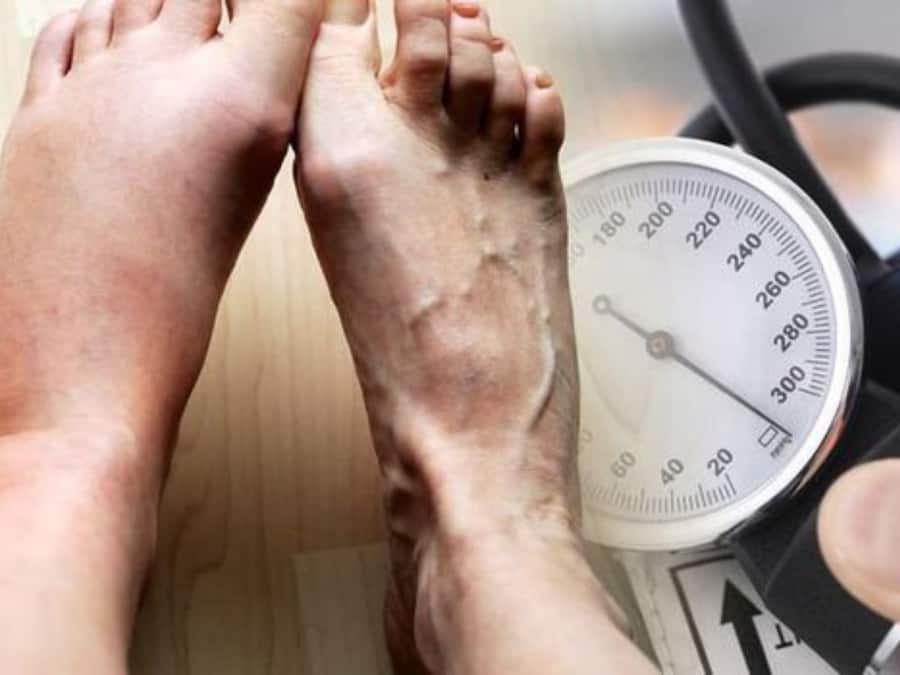 High Blood Pressure Symptoms: 10 Signs That Can Appear In Your Legs and ...