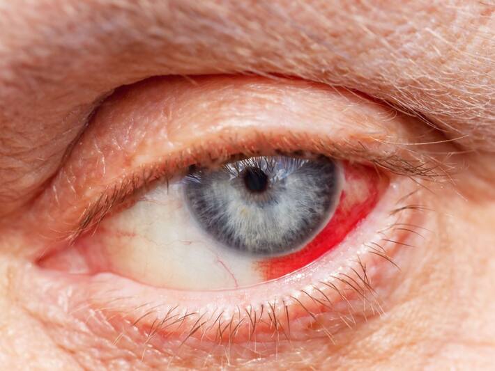 High Cholesterol Symptoms: These 7 Signs In Eyes Can Tell If You Have ...