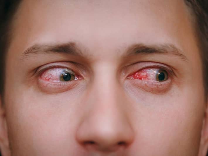Eye Infection Symptoms 5 Warning Signs You Should Never Ignore