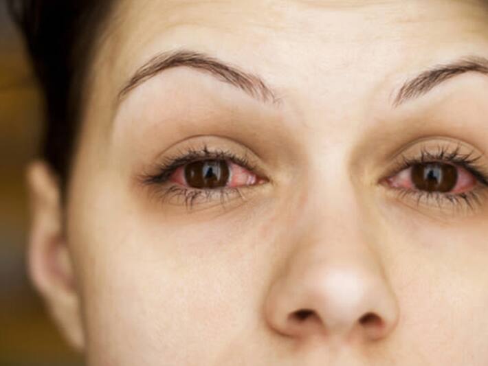 Conjunctivitis Cases On The Rise In Delhi: Symptoms, Causes And Everything You Need To Know ...