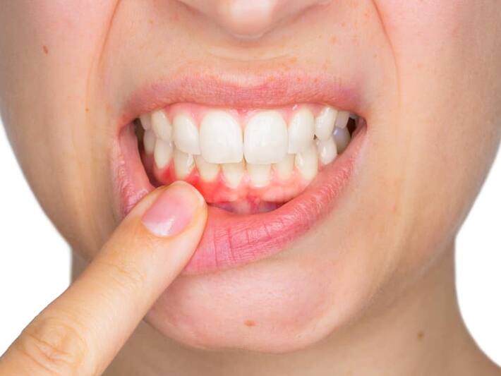 Oral Health: Understanding The Significance Of Gum Colour ...