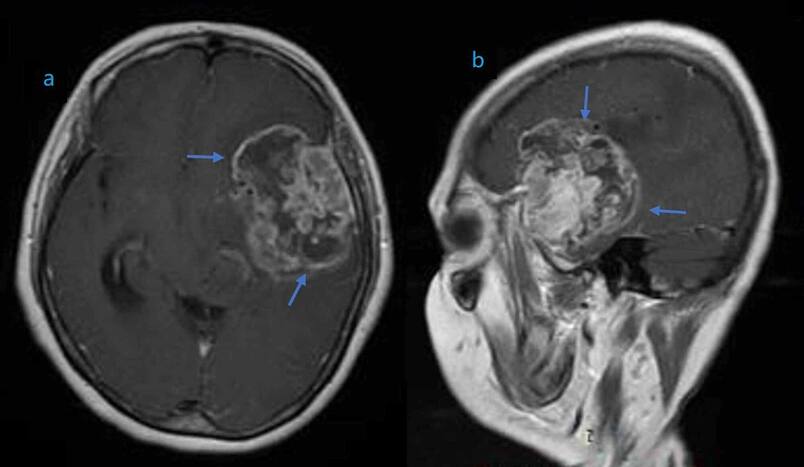 Pediatric Brain Tumors: Challenges And Long-Term Care | TheHealthSite.com