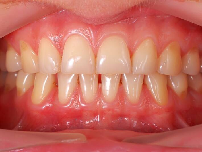 Oral Health: Understanding The Significance Of Gum Colour ...