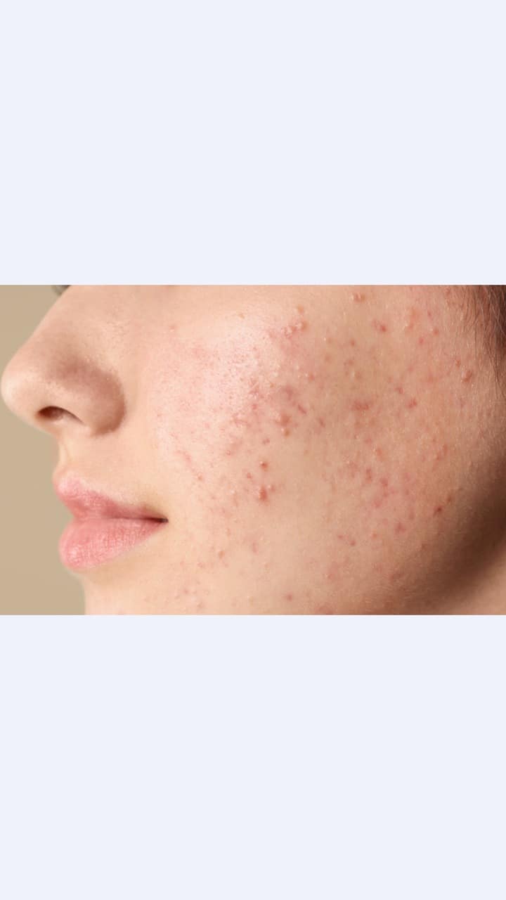 10 Common Myths About Acne And Pimples