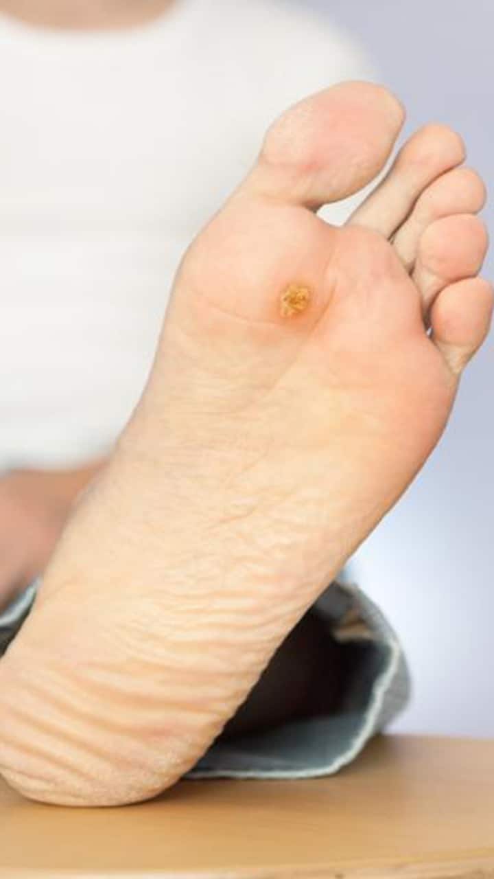Suffering From Diabetic Foot Ulcers? Add These 10 Foods In Your Diet