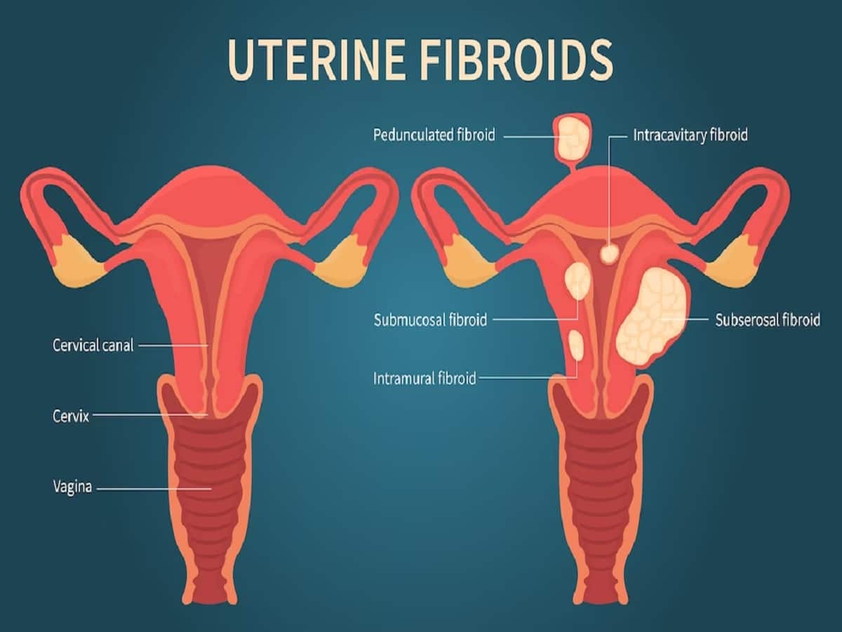 50% Spike In Uterine Fibroid Cases In Women Aged 30 And Above: Reasons ...