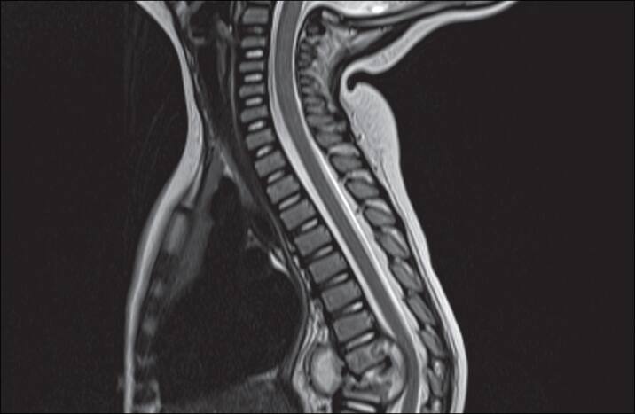 Spinal Tuberculosis Is Curable: Timely Detection And Medical Treatment ...