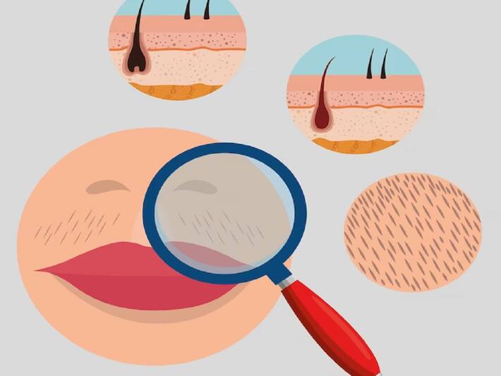 PCOS Awareness Month: 5 Telltale Signs That Indicate You Have The ...