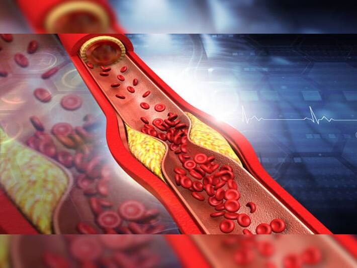 High Cholesterol Symptoms: 5 Uncommon High Cholesterol Signs To Look ...