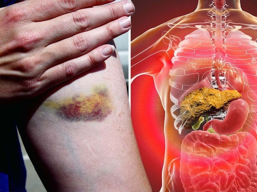 10 Early Signs of Liver Damage: Don't Ignore These Symptoms | TheHealthSite.com