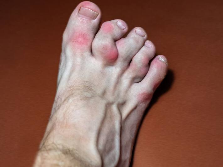 Damaged Pancreas: 5 Pancreatitis Symptoms That May Appear on Your Legs ...