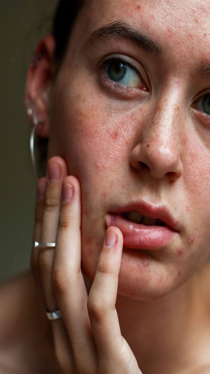 9 Eating Habits That Might Harm Your Skin
