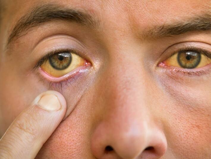 Yellow Tongue: 5 Diseases That Can Change Your Tongue Into Pale Yellow ...