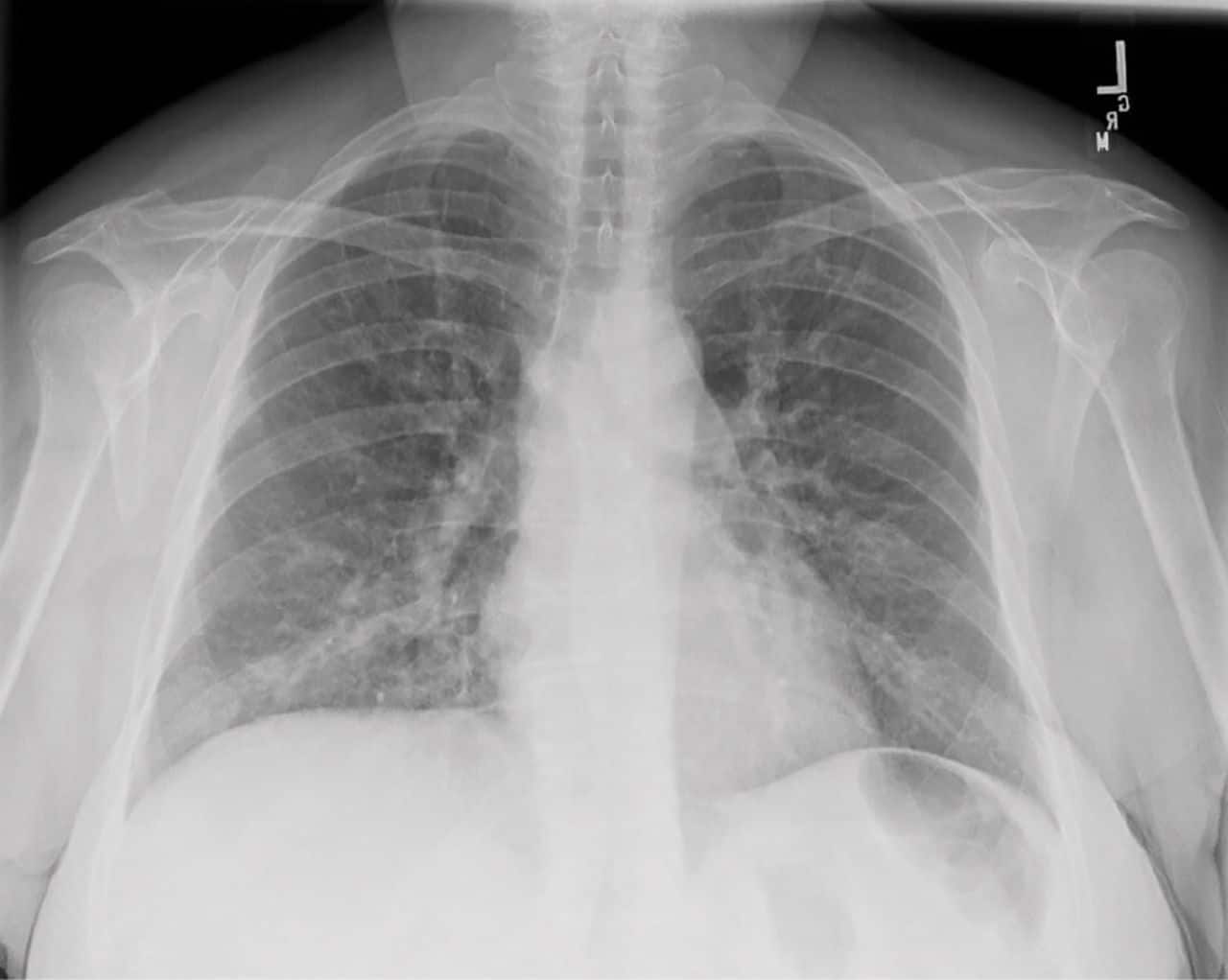 What Is Multifocal Pneumonia? Causes, Symptoms And Treatment ...