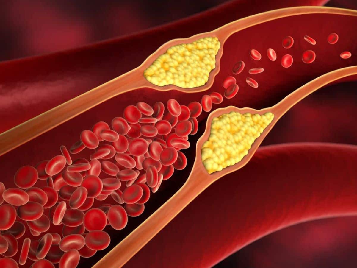 High Cholesterol Management Tips: 7 Morning Routine To Reduce Bad LDL ...