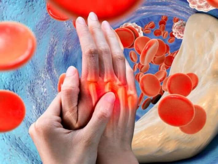 5 High Cholesterol Symptoms That May Appear On Your Feet And Legs At