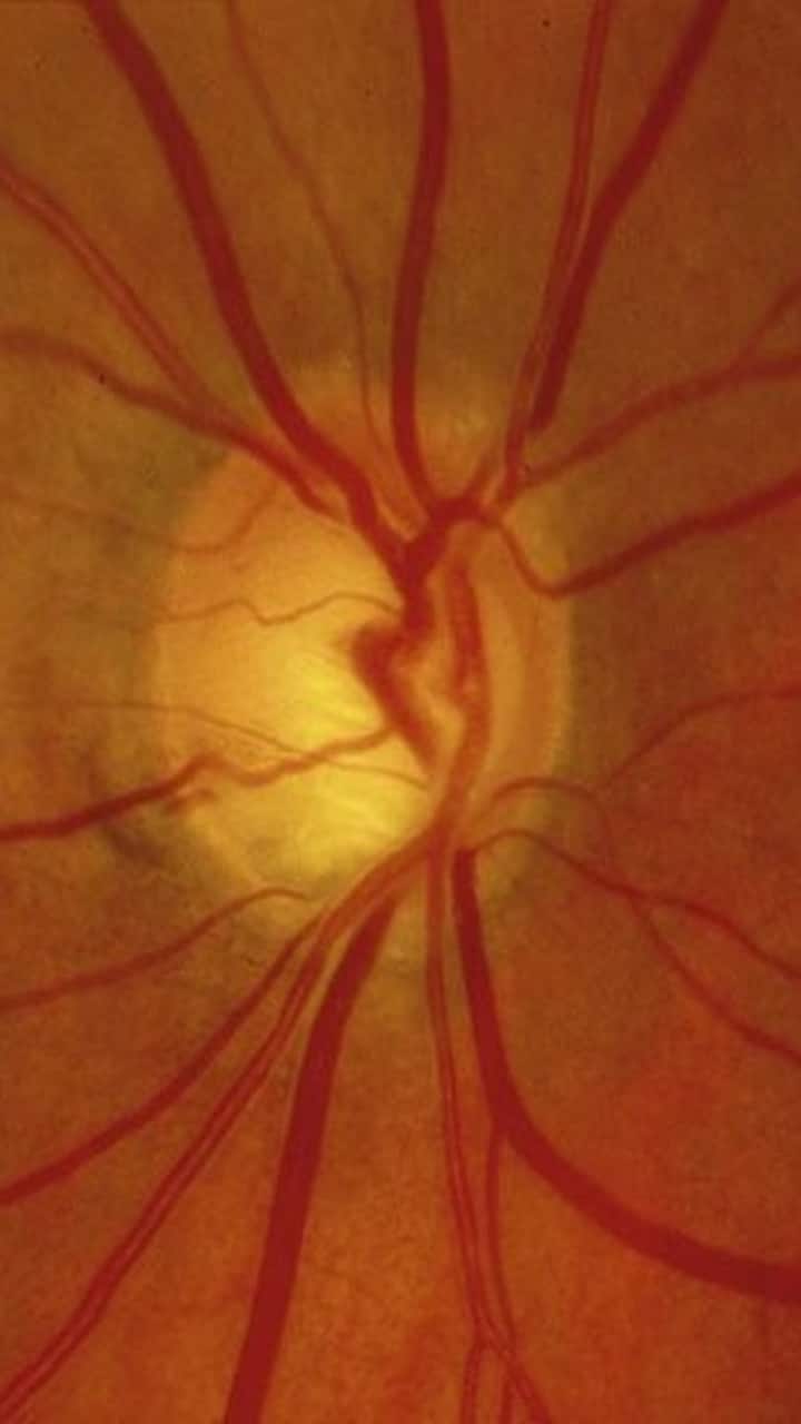 Losing Your Peripheral Vision? 8 Shocking Causes You Can't Ignore