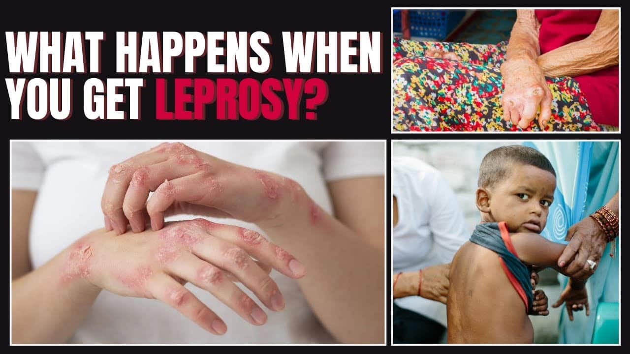Leprosy Symptoms Types And Whos At Risk Everything You Need To Know