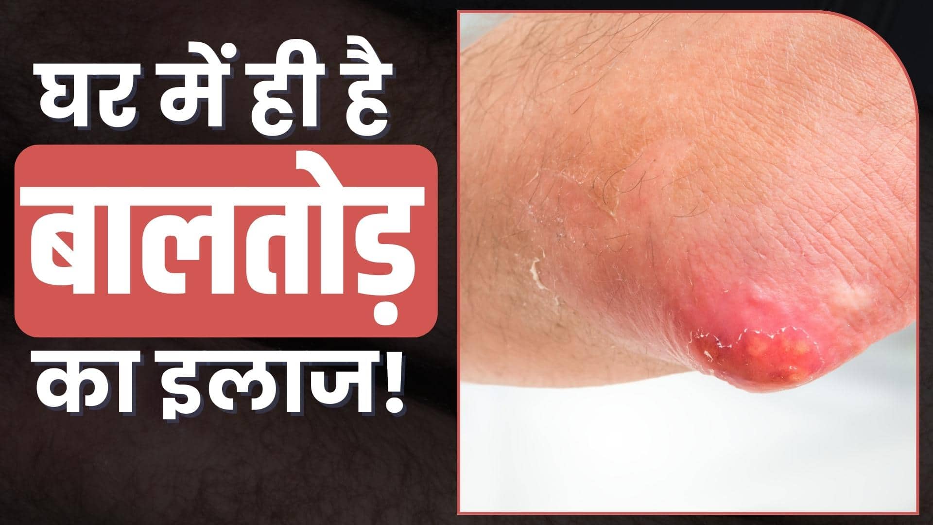 Baltod Remedies: बालतोड़ का इलाज करेंगे घर में रखीं ये चीजें, देखें ये ...