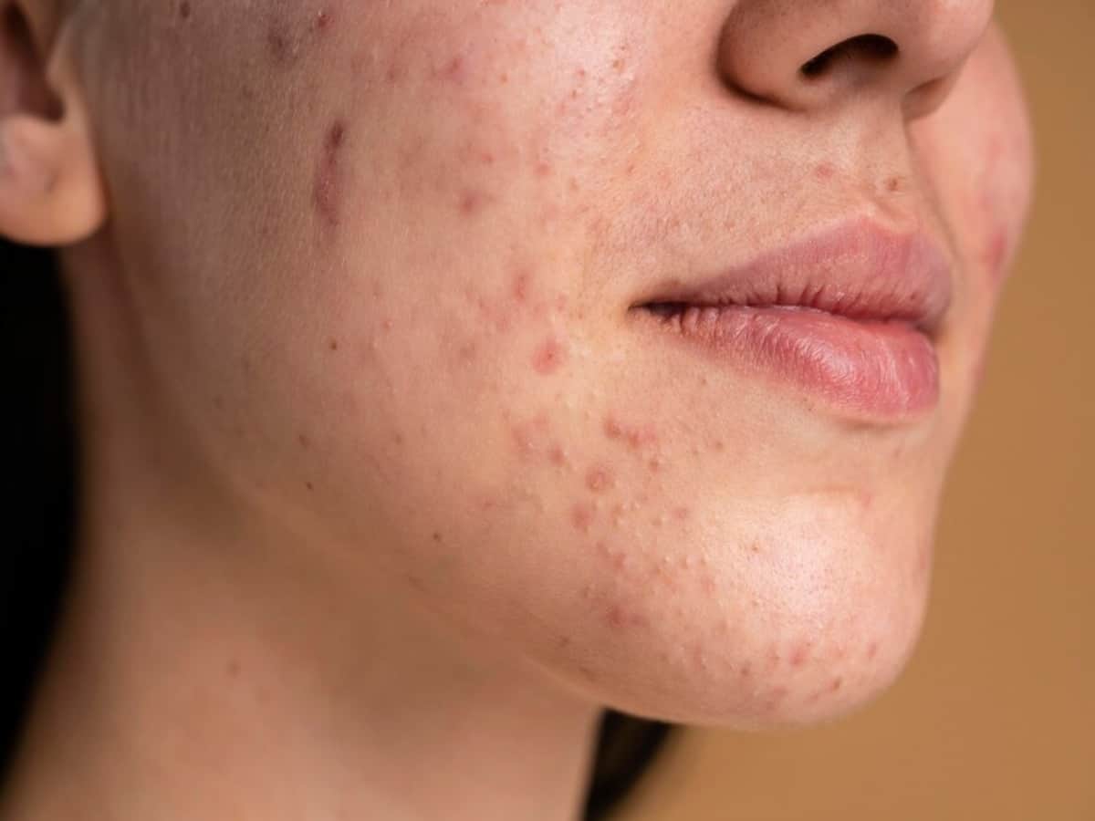 Do You Suffer From Acne? Avoid Making These 3 Skincare Mistakes ...
