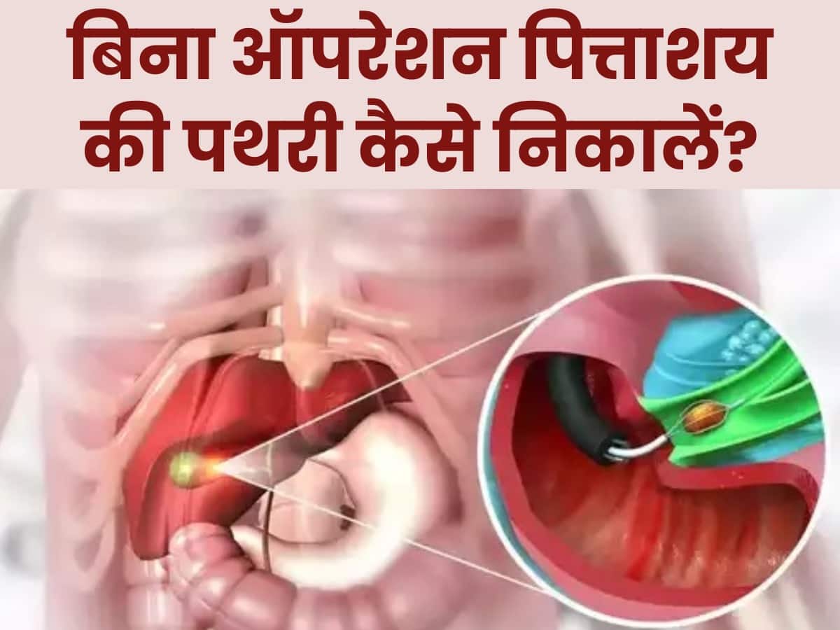 pitt ki thaili ki pathri ka gharelu upay | पित्त की थैली में पथरी होने पर दिखते हैं ये लक्षण ...