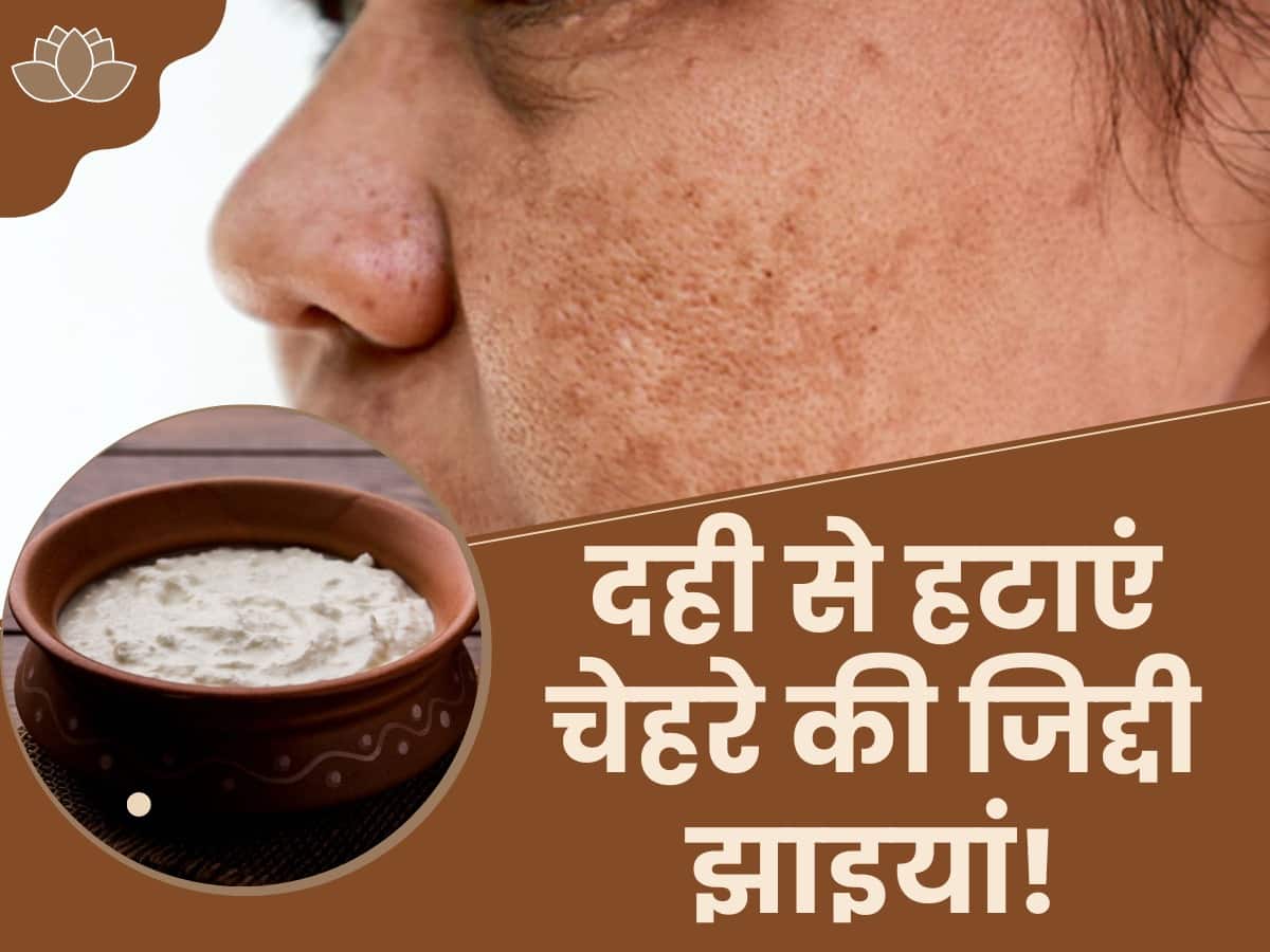 Dahi Se Jhaiya Kaise Hataye | जिद्दी झाइयां हटाने के लिए दही में मिलाकर ...