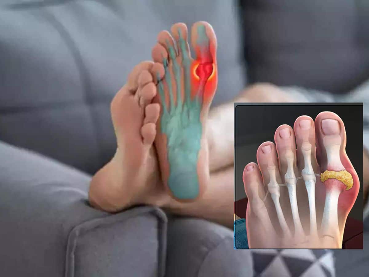 High Uric Acid Symptoms In Men: Top 7 Signs of High Uric Acid Levels In ...