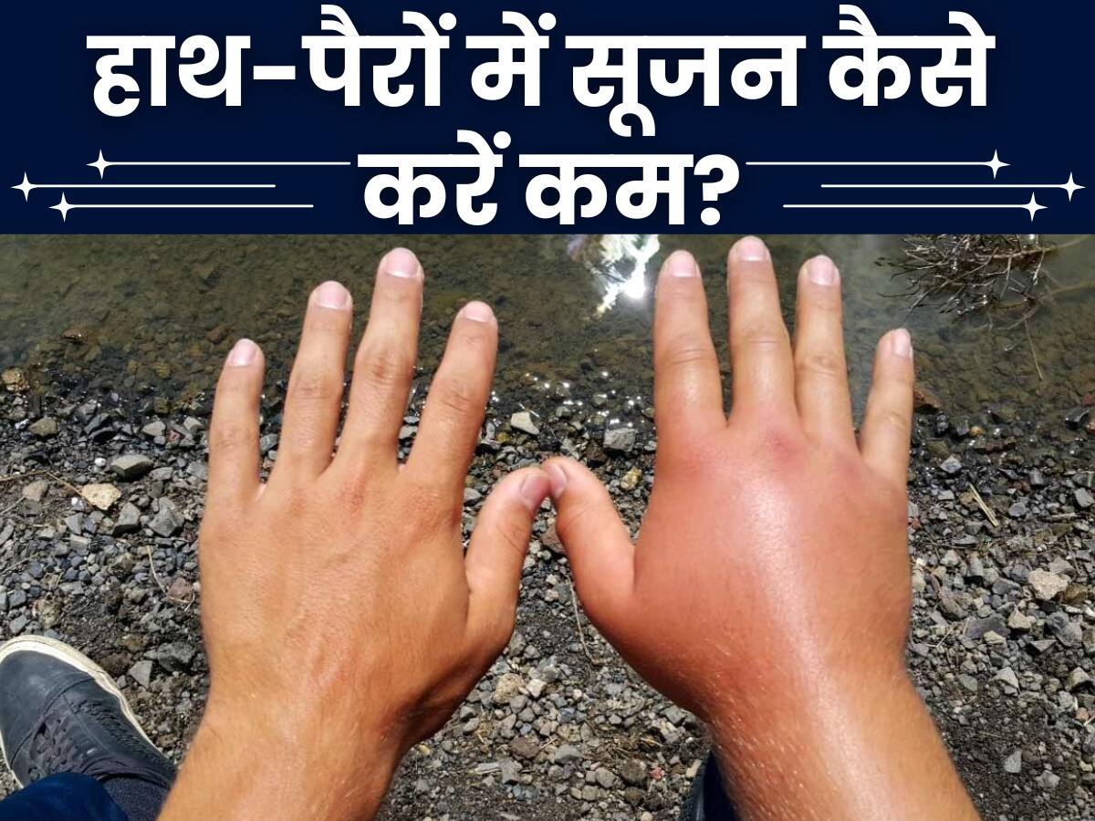 Swelling in hands and feet | हाथ-पैरों क सूजन को कम करने के लिए करें ये ...