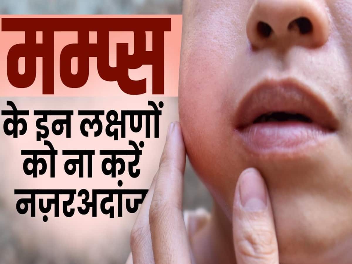 Mumps Symptoms: मंप्स होने पर दिखते हैं ये लक्षण! जानें क्या करें ...