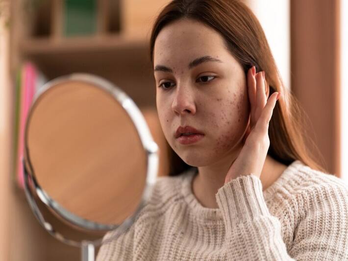 Suffering From Acne Routinely? Here Are Important Things To Know ...