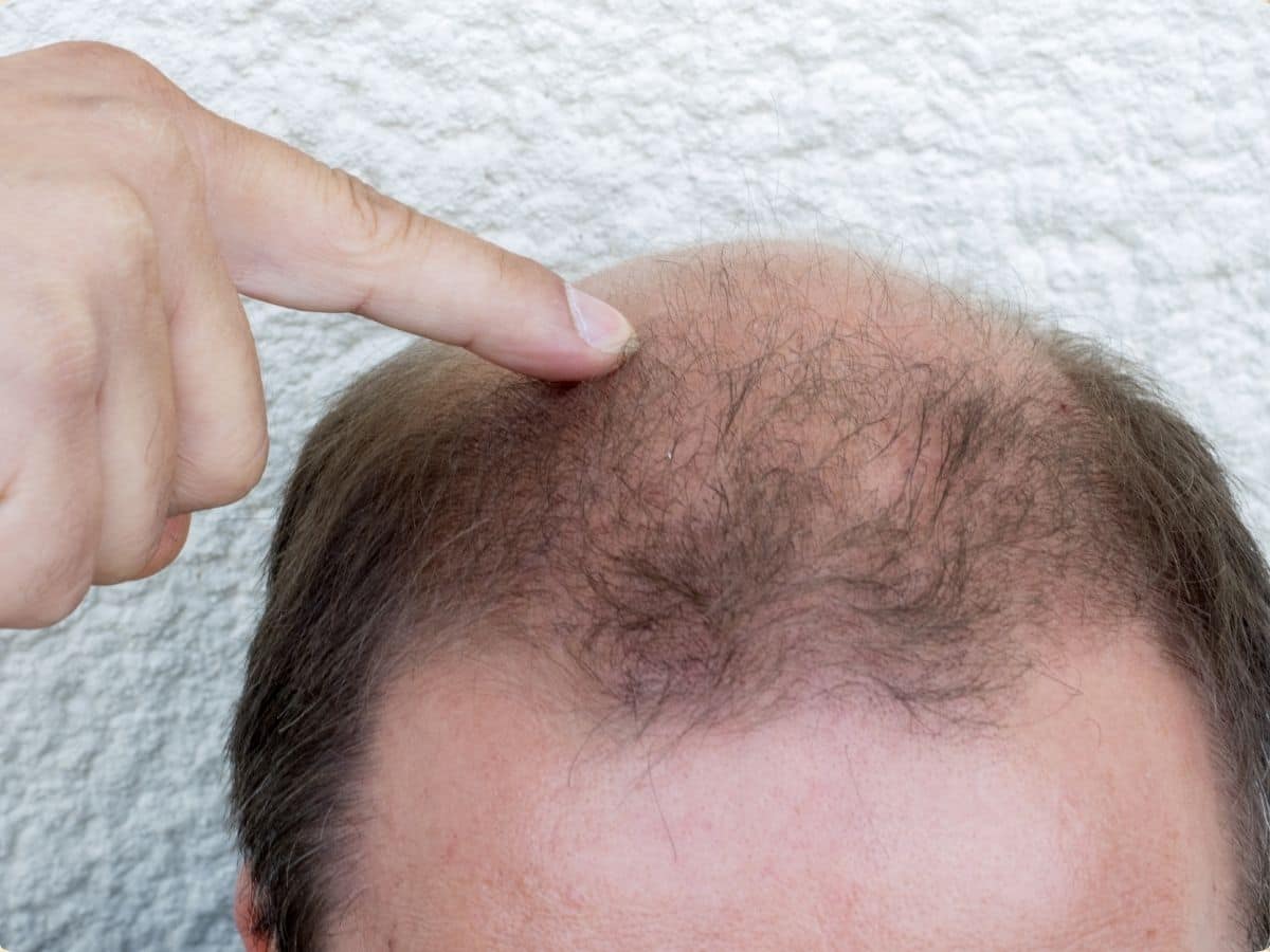 Hairfall Remedies for Men: Top 5 Best Supplements For Men To Stop ...