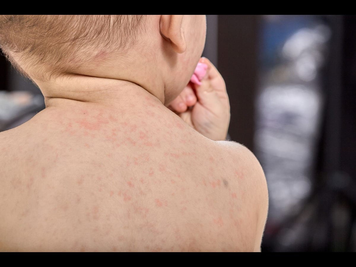 Roseola Rash Toddler MASTERING CHILDHOOD RASHES MEASLES RUBELLA