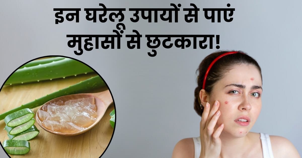 Pimples Se Kaise Chhutkara Paye | उमस और पसीने से चेहरे पर निकल रहे हैं ...