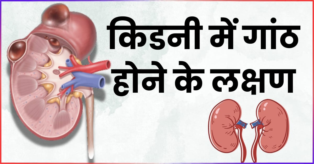 Kidney Me Ganth Ke Lakshan | किडनी सिस्ट (गांठ) क्या है? क्यों हो सकता ...