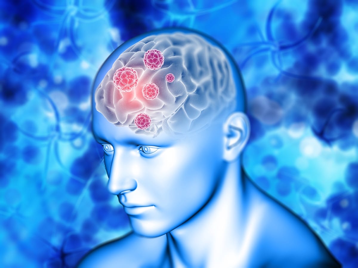 Morning Stroke: What Are The Tell-Tale Signs Of A Fatal Brain Stroke ...