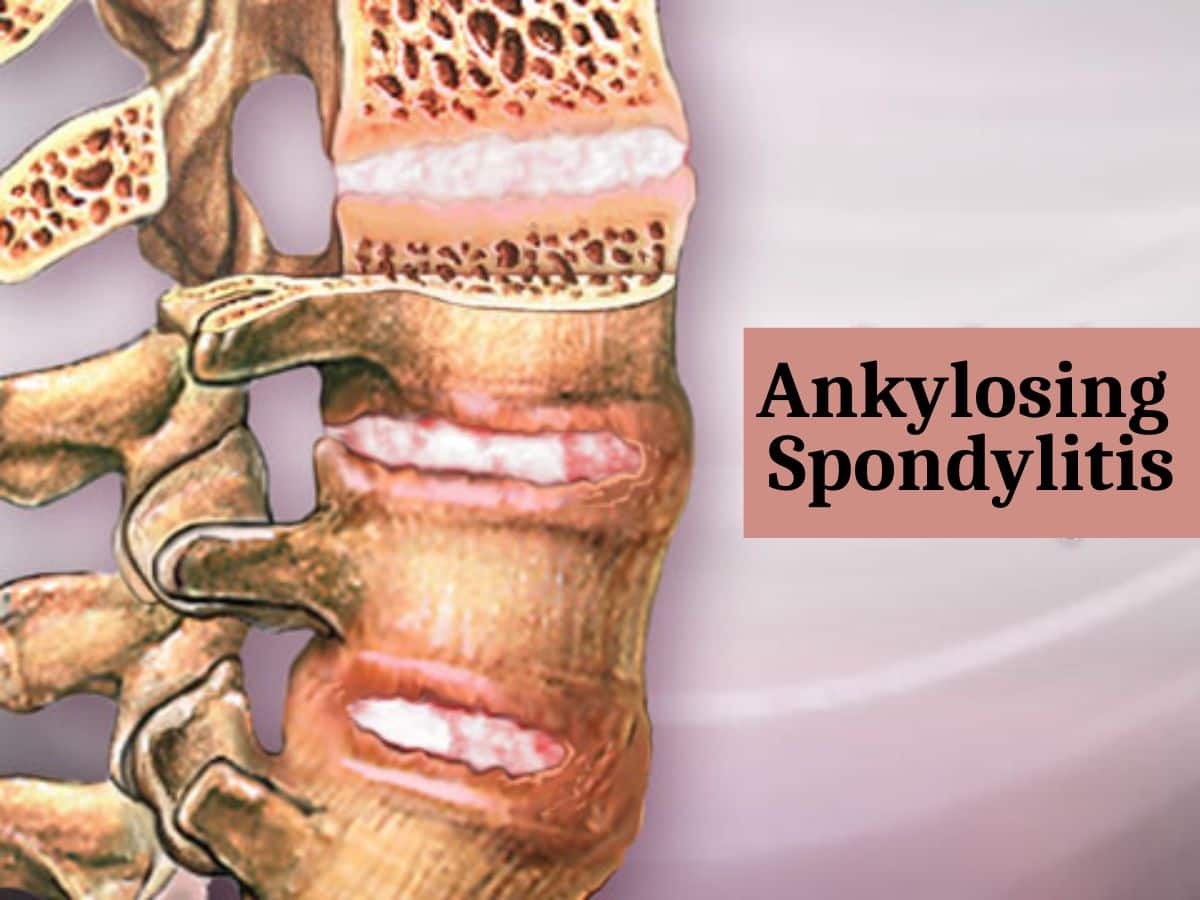 Know All About Ankylosing Spondylitis